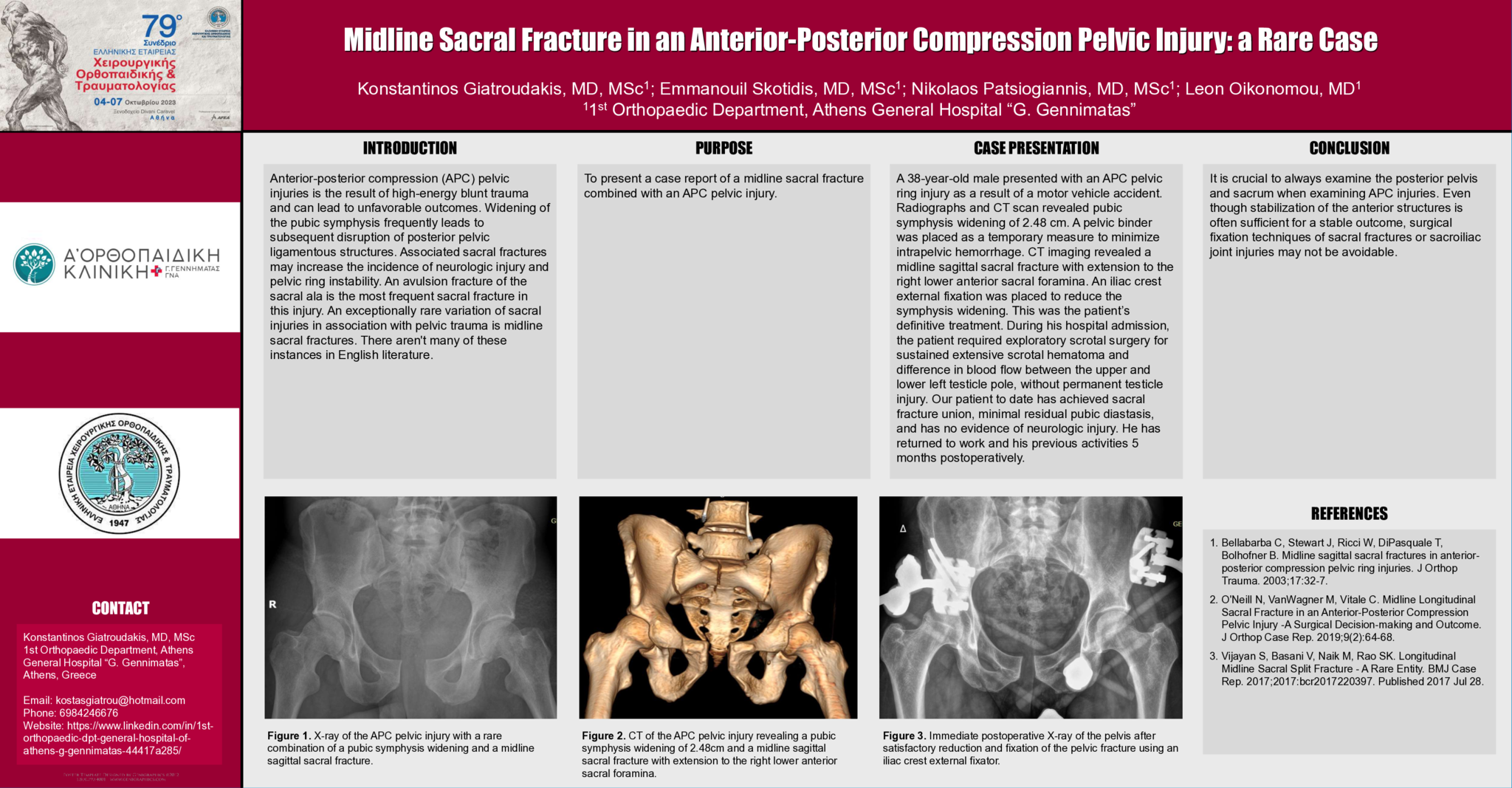 MIDLINE SACRAL FRACTURE IN AN ANTERIOR-POSTERIOR COMPRESSION PELVIC ...